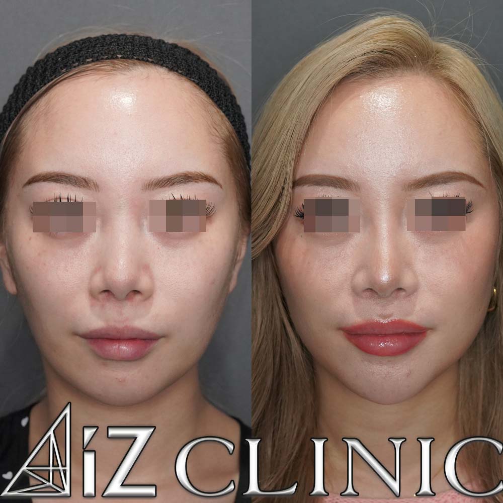 麻酔(静脈麻酔・笑気麻酔・麻酔クリーム)について｜美容外科・美容皮膚科AiZクリニック ｜AiZクリニック（アイズクリニック）美容外科・美容皮膚科