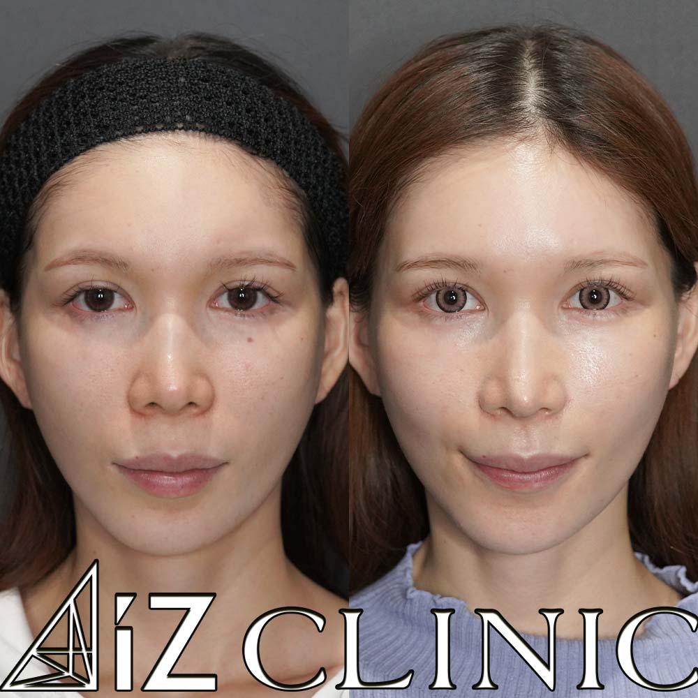 麻酔(静脈麻酔・笑気麻酔・麻酔クリーム)について｜美容外科・美容皮膚科AiZクリニック ｜AiZクリニック（アイズクリニック）美容外科・美容皮膚科