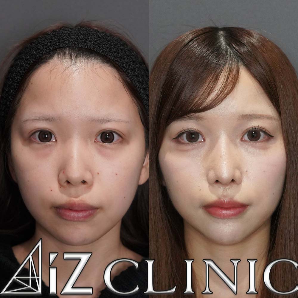 麻酔(静脈麻酔・笑気麻酔・麻酔クリーム)について｜美容外科・美容皮膚科AiZクリニック ｜AiZクリニック（アイズクリニック）美容外科・美容皮膚科